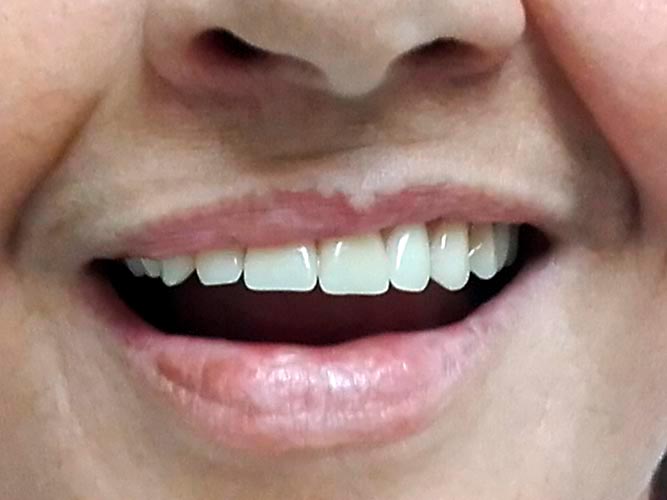 Prótesis dentales completas - Clínica de Prótesis e Implantes
