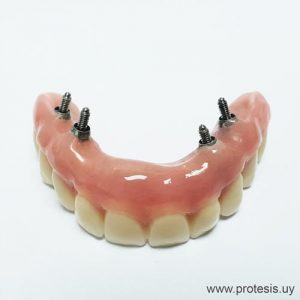 Prótesis completas con implantes - Clínica de Prótesis e Implantes