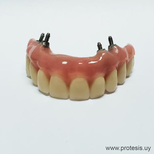 Prótesis completas con implantes - Clínica de Prótesis e Implantes