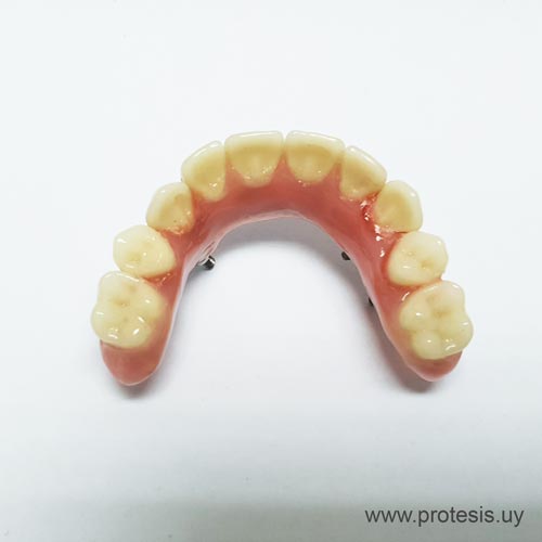 Prótesis completas con implantes - Clínica de Prótesis e Implantes