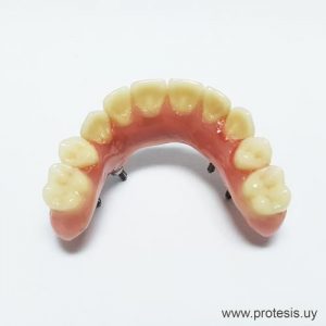 Prótesis completas con implantes - Clínica de Prótesis e Implantes